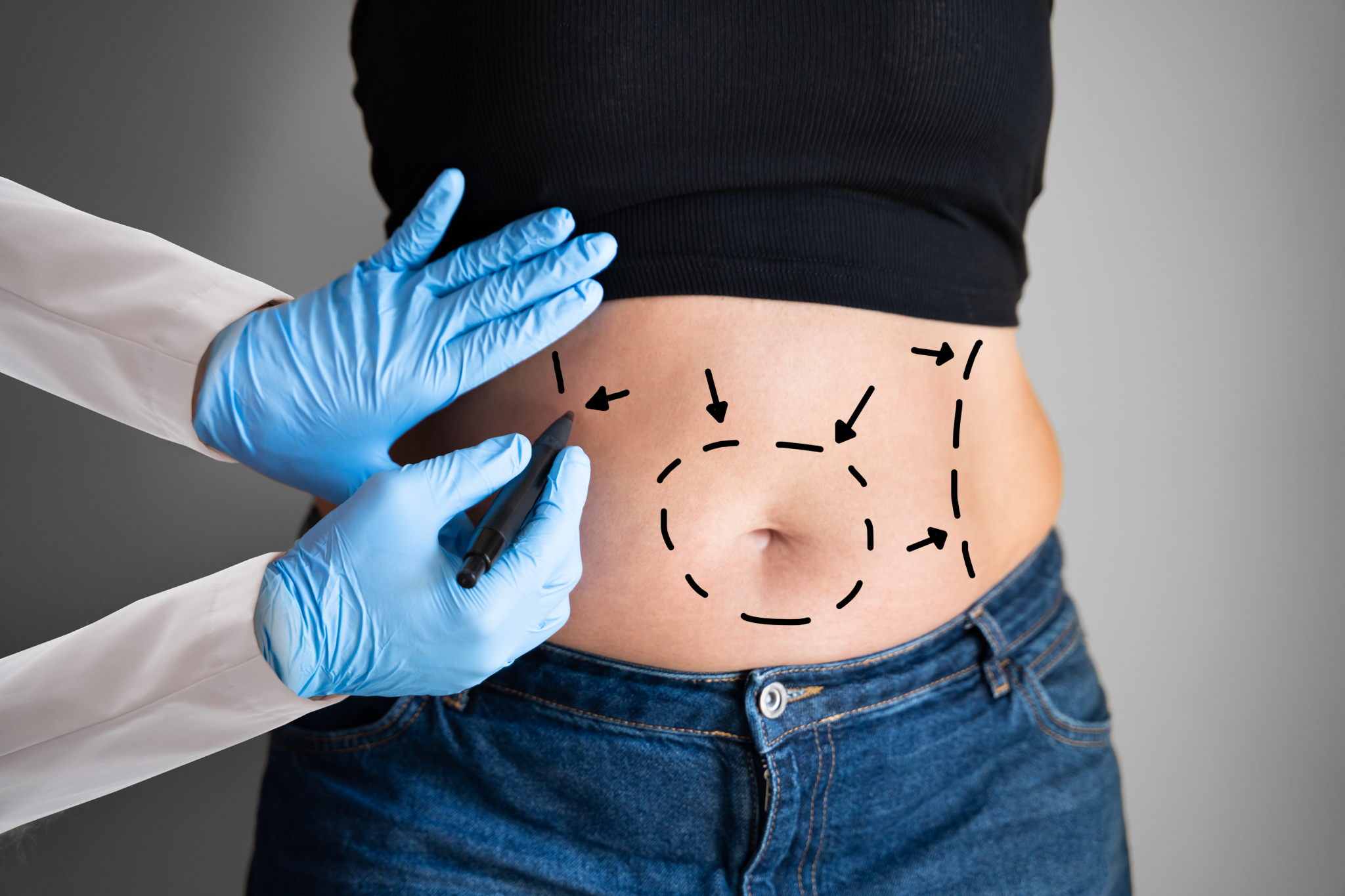 Vaser Liposuction high-def 2026
