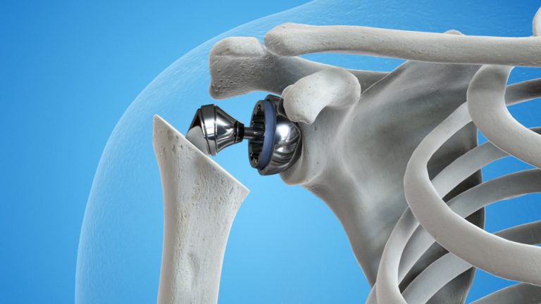 Shoulder Joint Replacement 2025