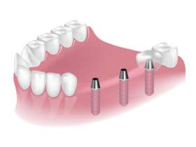 Single Stage Implant 2024